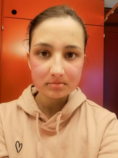 Bimax-Operation Erfahrungsbericht einer Betroffenen